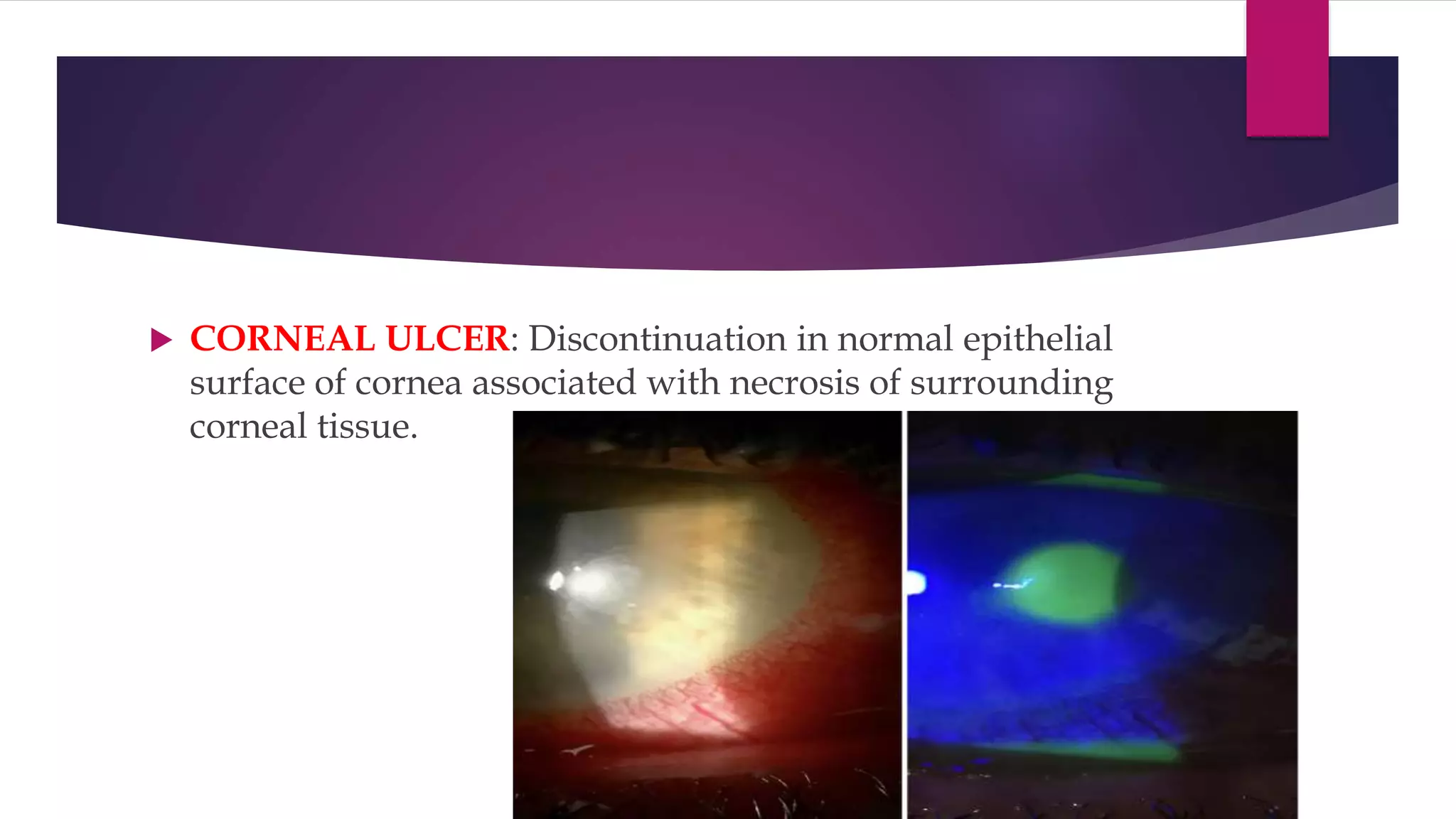 ULCER.pptx