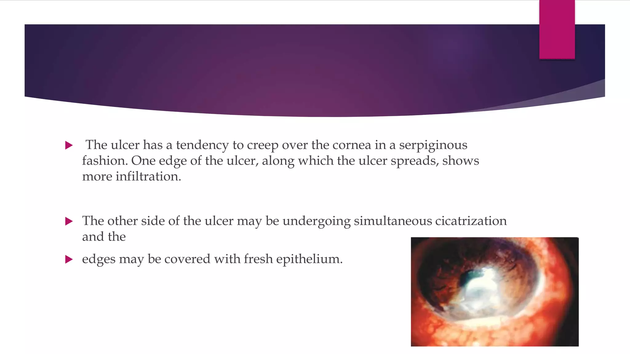 ULCER.pptx