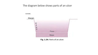 ULCER.pptx