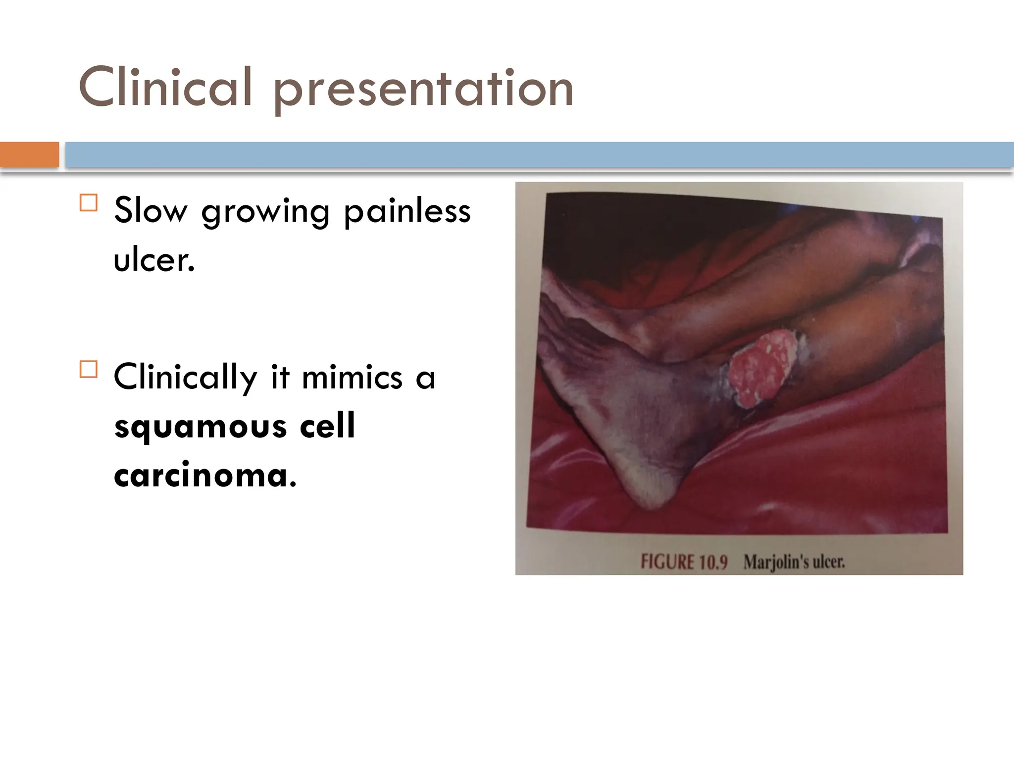 Ulcer ppt by the surgery department of hospital | PPTX