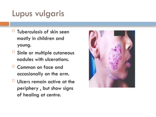 Ulcer ppt by the surgery department of hospital | PPTX