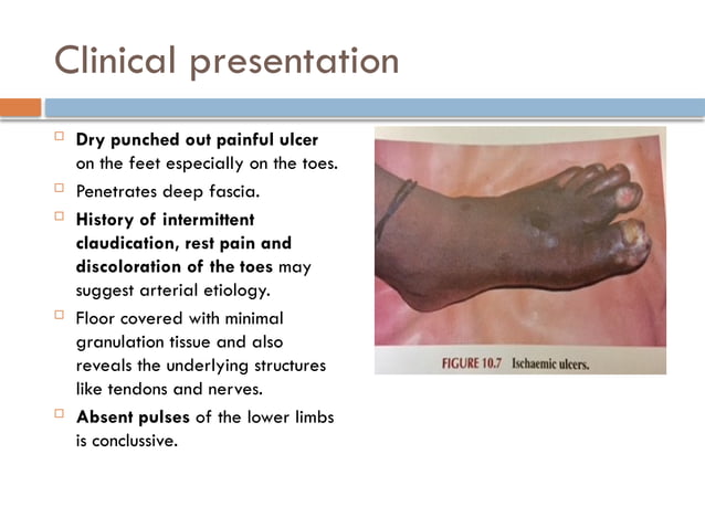 Ulcer ppt by the surgery department of hospital | PPT