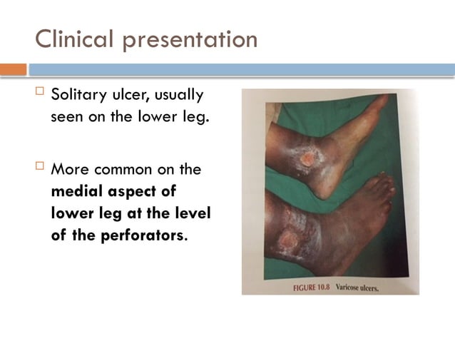 Ulcer ppt by the surgery department of hospital | PPT
