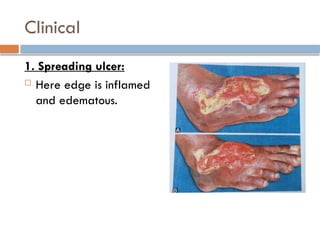 Ulcer ppt by the surgery department of hospital | PPTX
