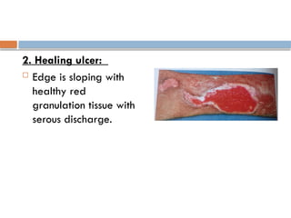 Ulcer ppt by the surgery department of hospital | PPTX