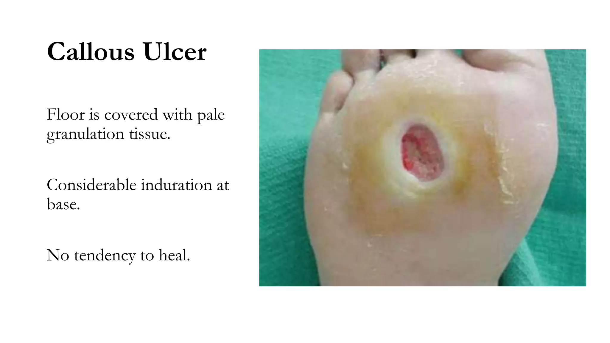 Ulcer (2) | PPTX
