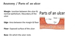 Ulcer (2) | PPT