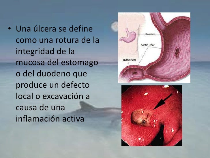 Ulcera peptica gastrica y duodenal