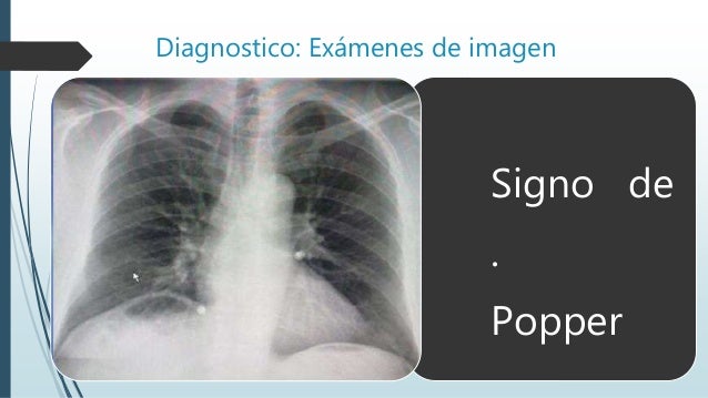 Ulcera peptica perforada