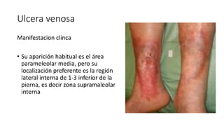 Ulceras.pptx