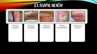 ULCERAS.pptx