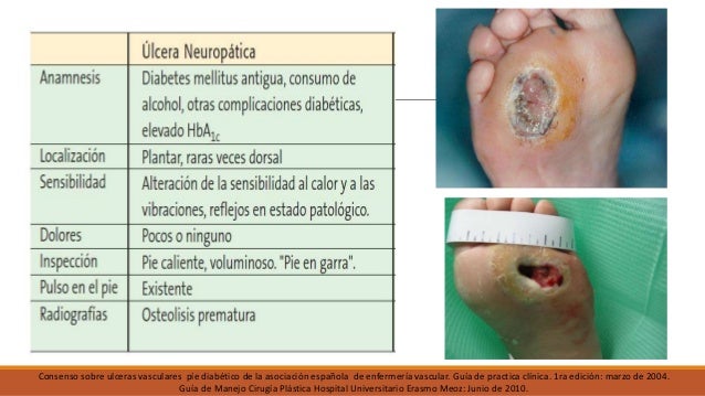 Ulceras en miembros inferiores