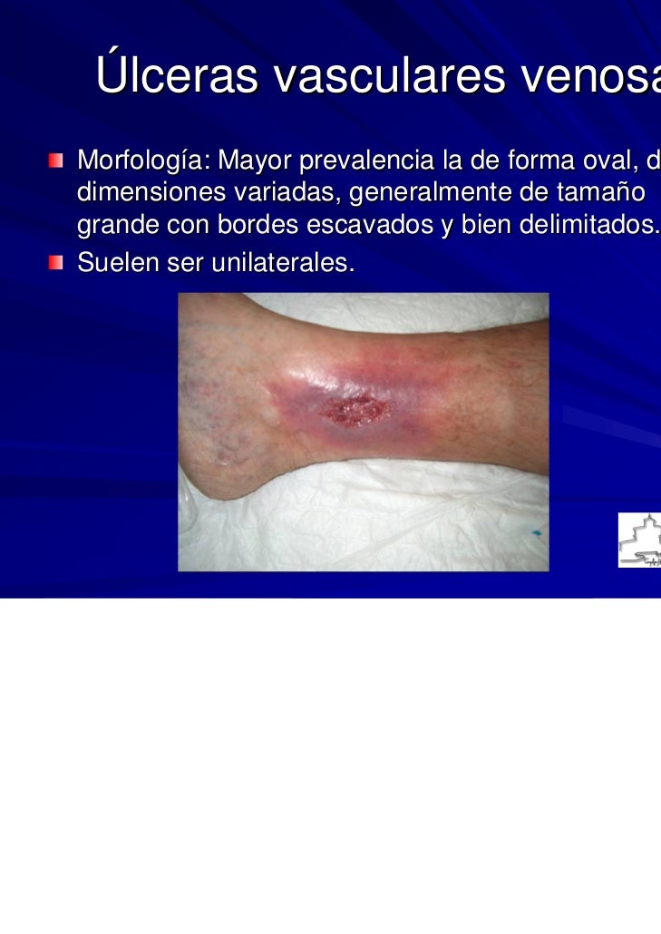 Ulceras vasculares