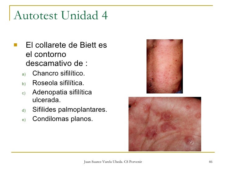 Ulceras anogenitales.ud4