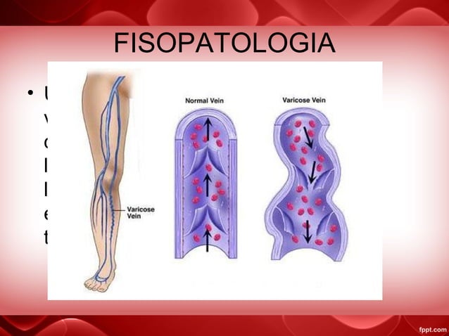 Ulceras arteriovenosas | PPT