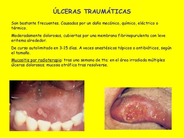 (2015-05-14) Ulceras orales (PPT)