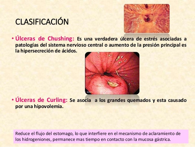 Ulceras por estrés (Cushing y Curling)