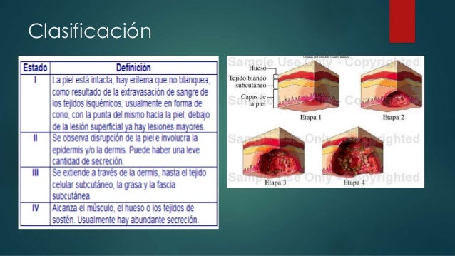 Lesiones Por Presion