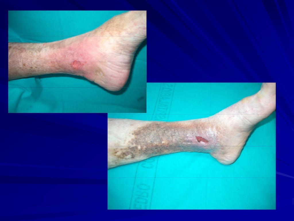 Ulceras Vasculares
