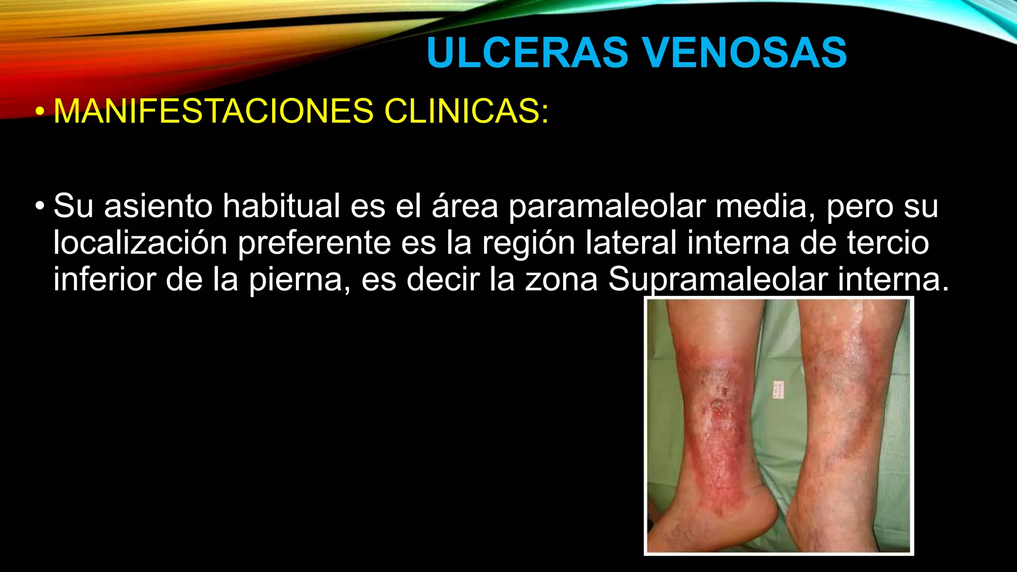 Ulceras vasculares CARLOS MATOS | PPT
