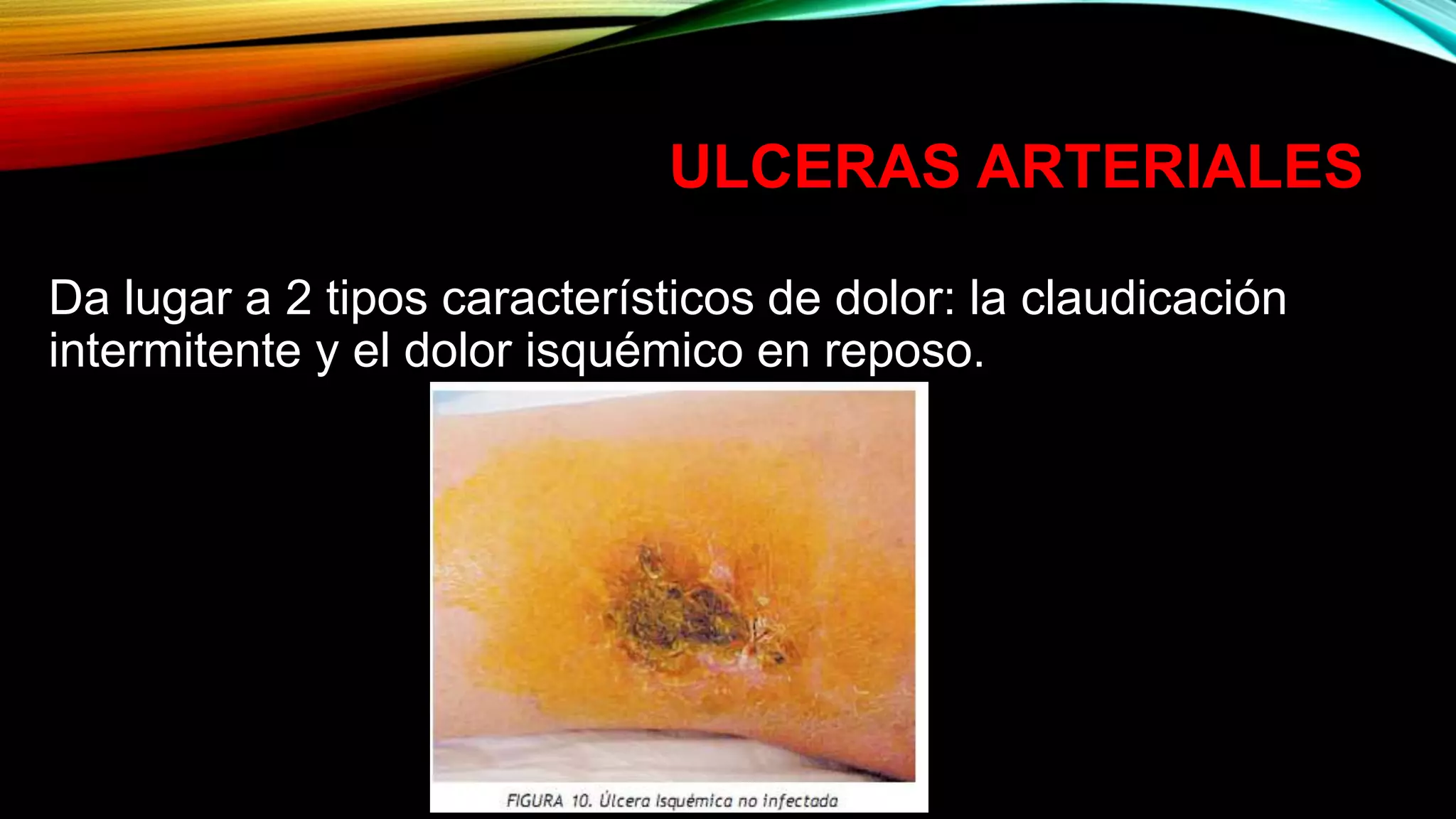 Ulceras vasculares CARLOS MATOS | PPT
