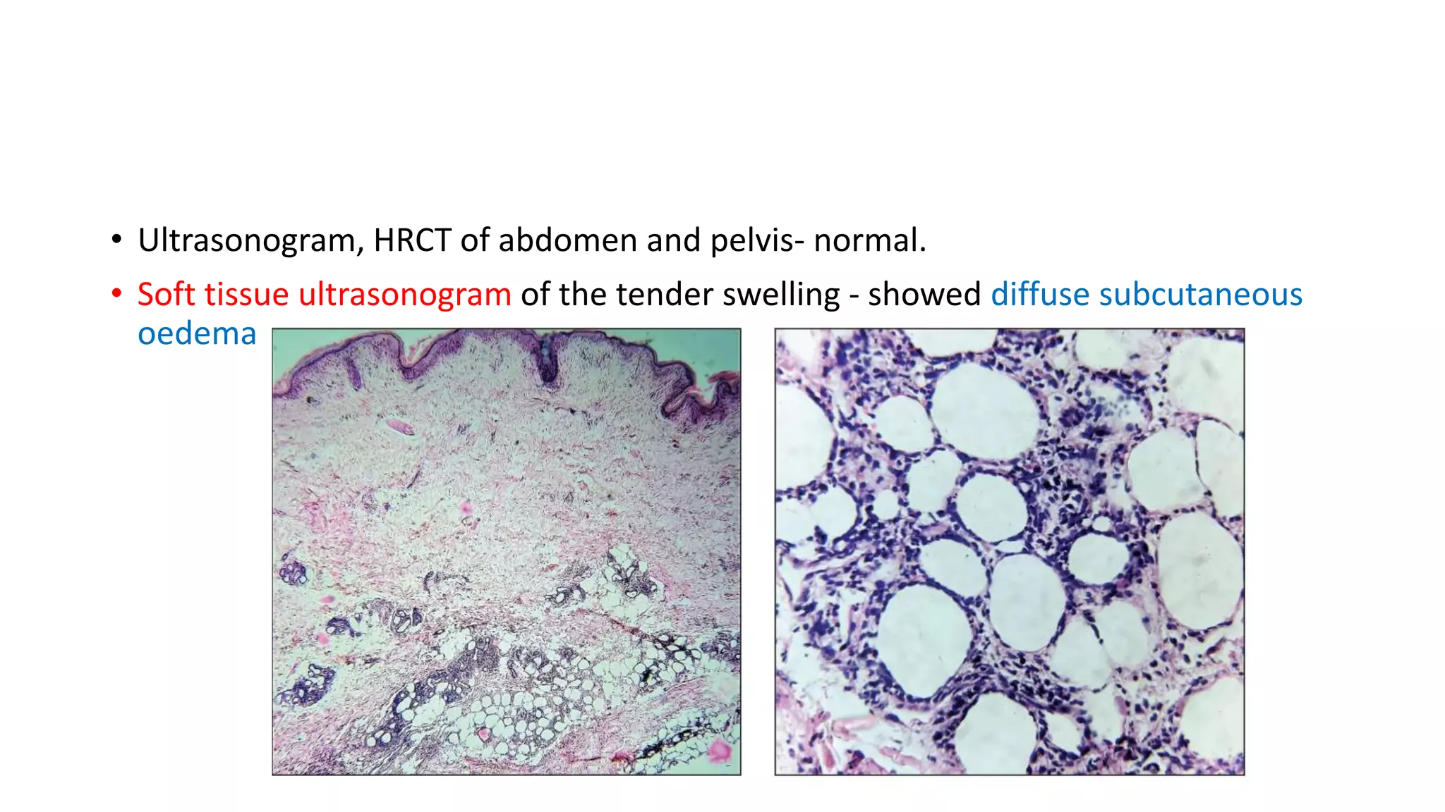 Ulcerated lobular panniculitis.pptx