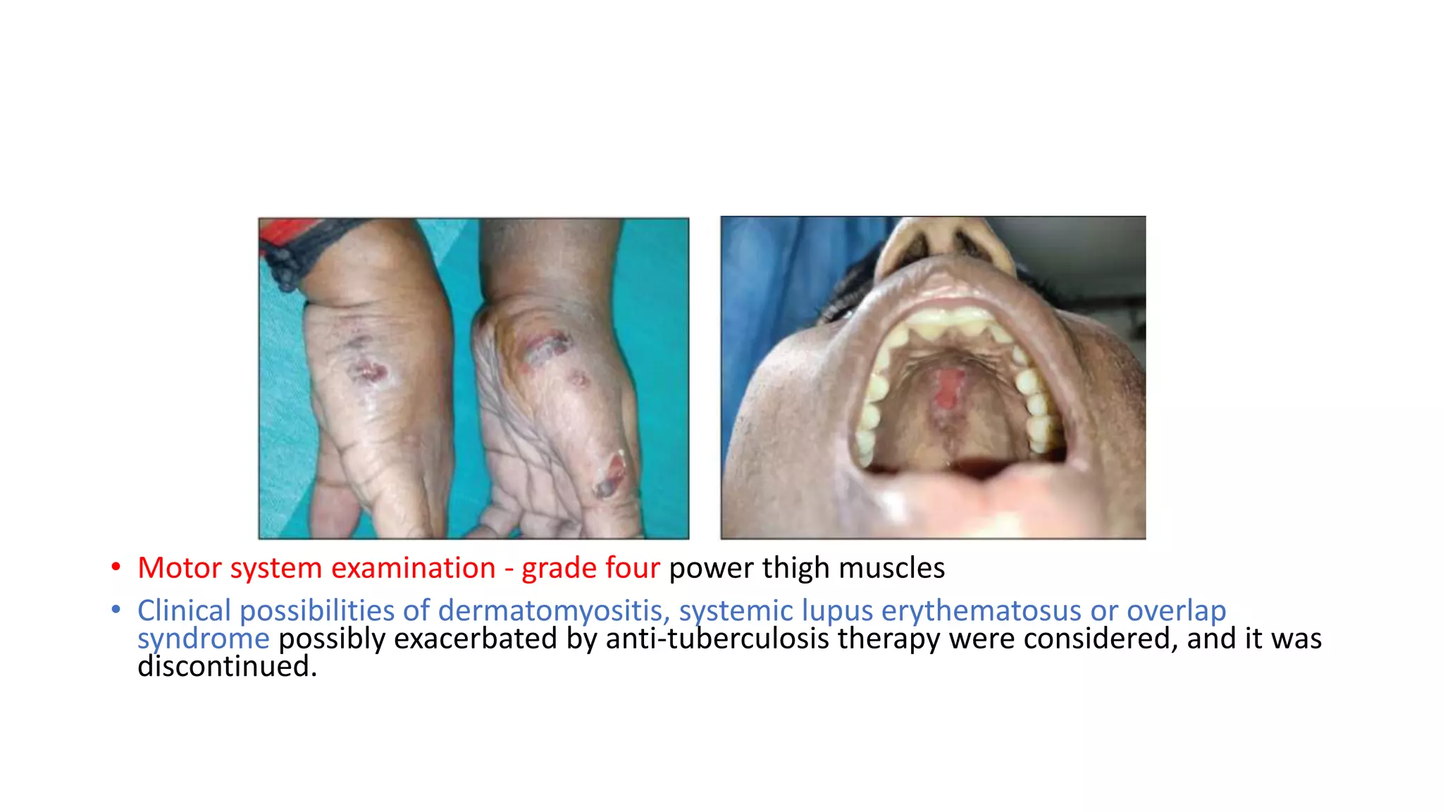 Ulcerated lobular panniculitis.pptx