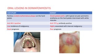Ulcerated lobular panniculitis.pptx