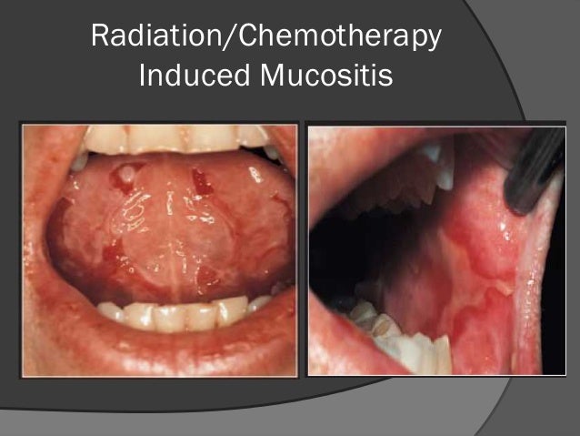 Ulceration slides-090331