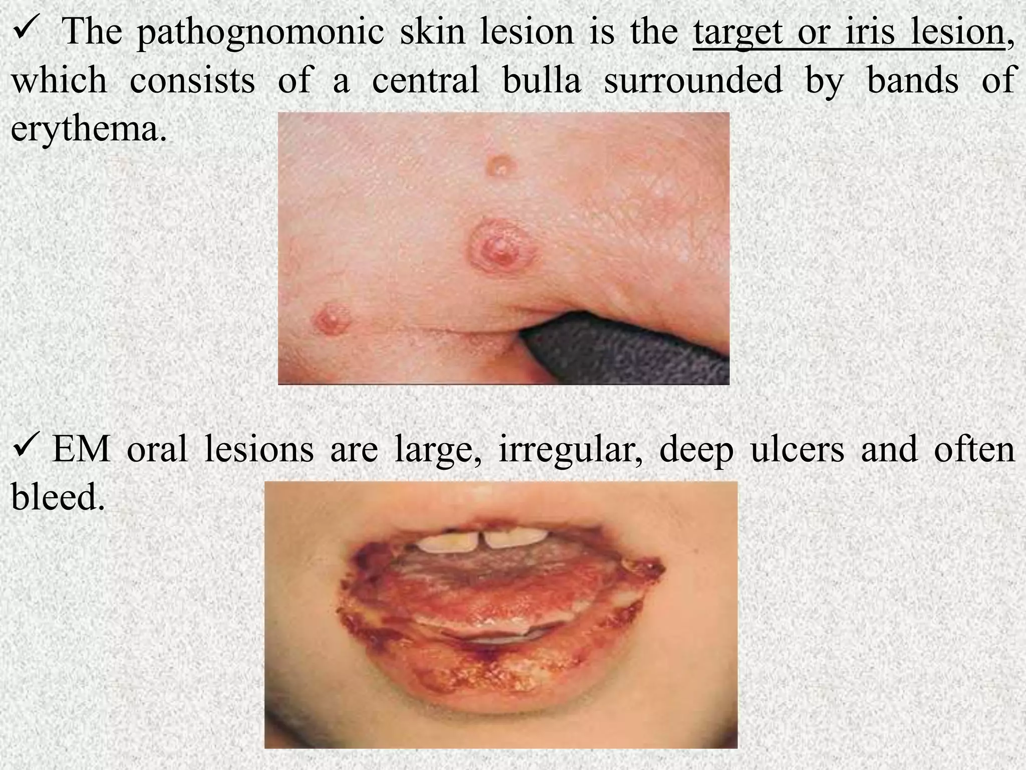 Ulcerative lesions | PPTX