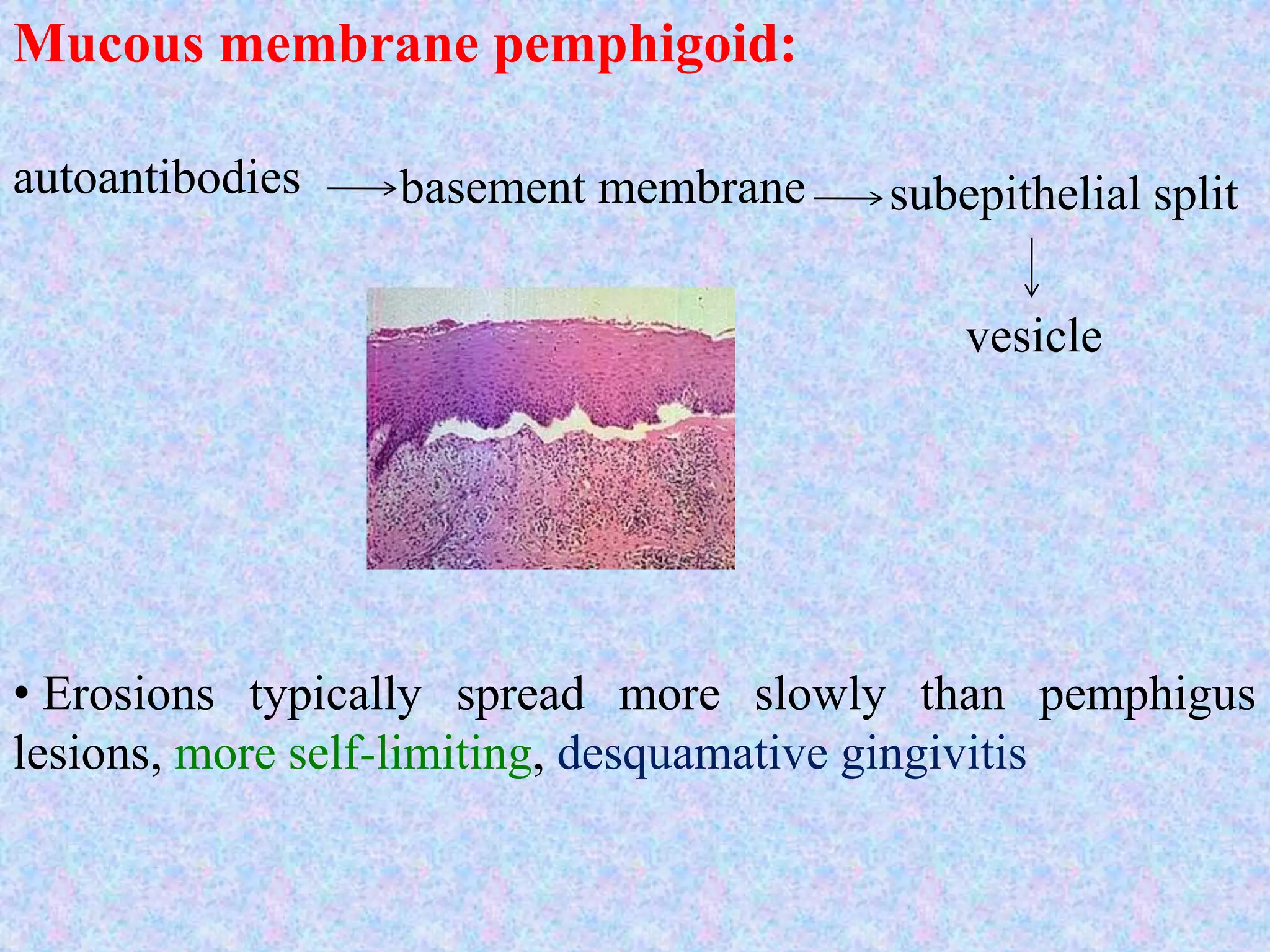 Ulcerative lesions | PPTX