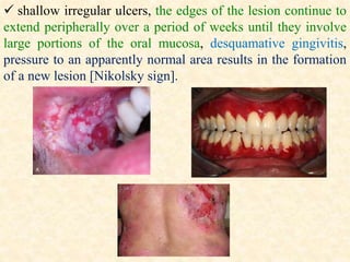 Ulcerative lesions | PPTX