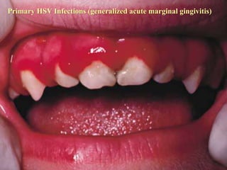 Ulcerative lesions | PPTX