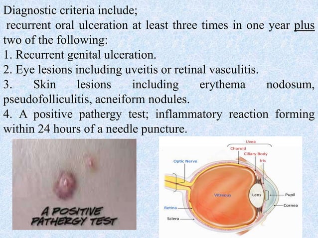 Ulcerative lesions