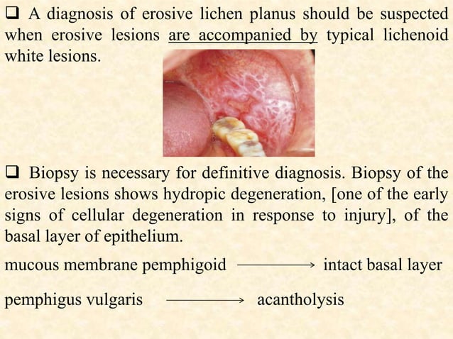 Ulcerative lesions