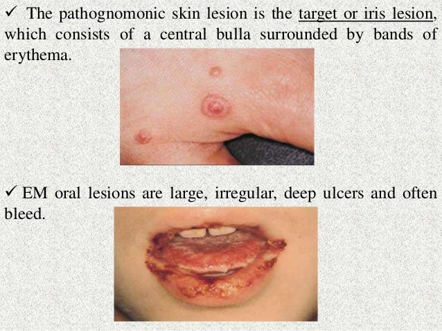 Ulcerative lesions