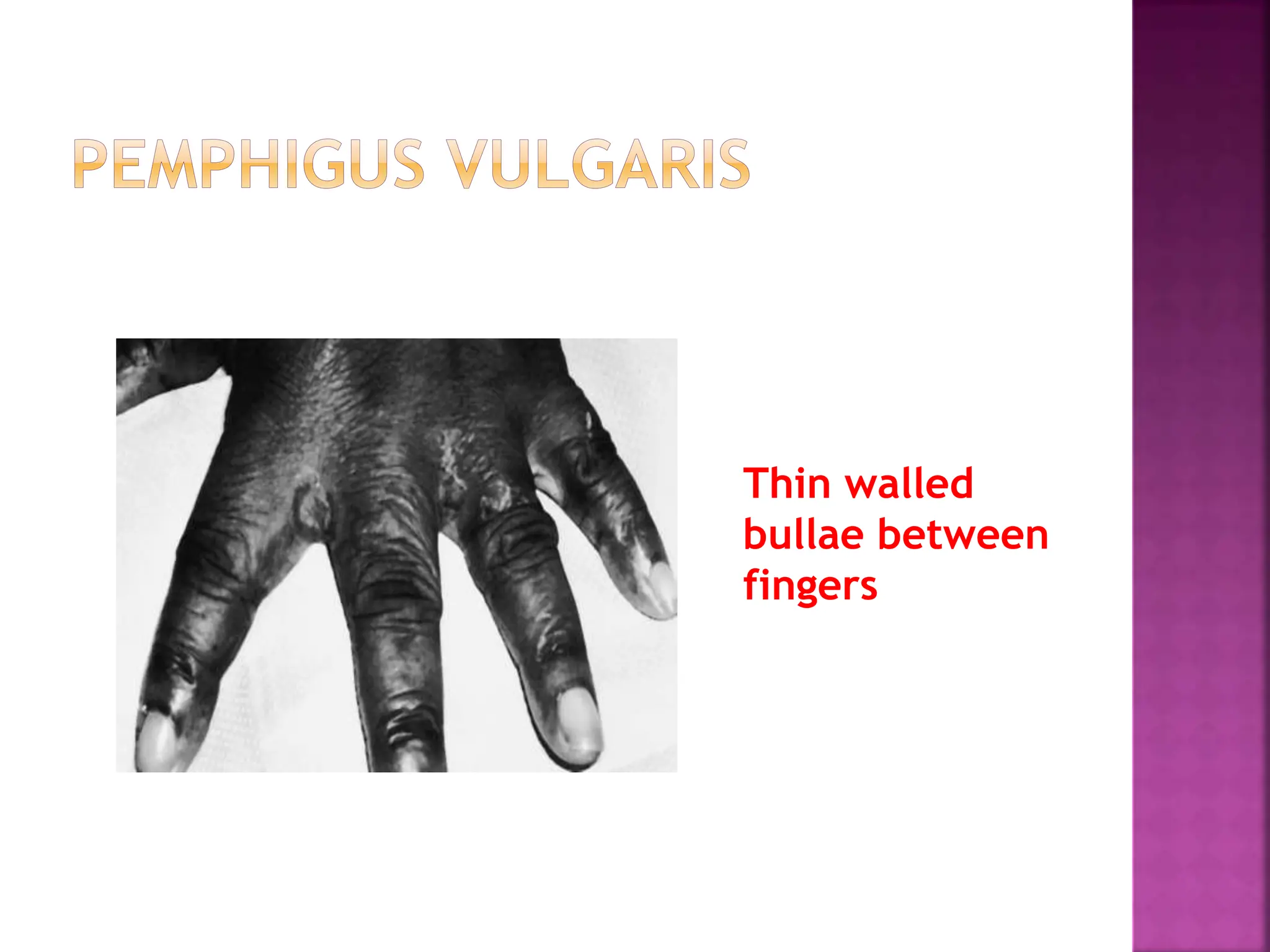 ULCERATIVE AND VESICULO BULLOUS LESIONS.pptx
