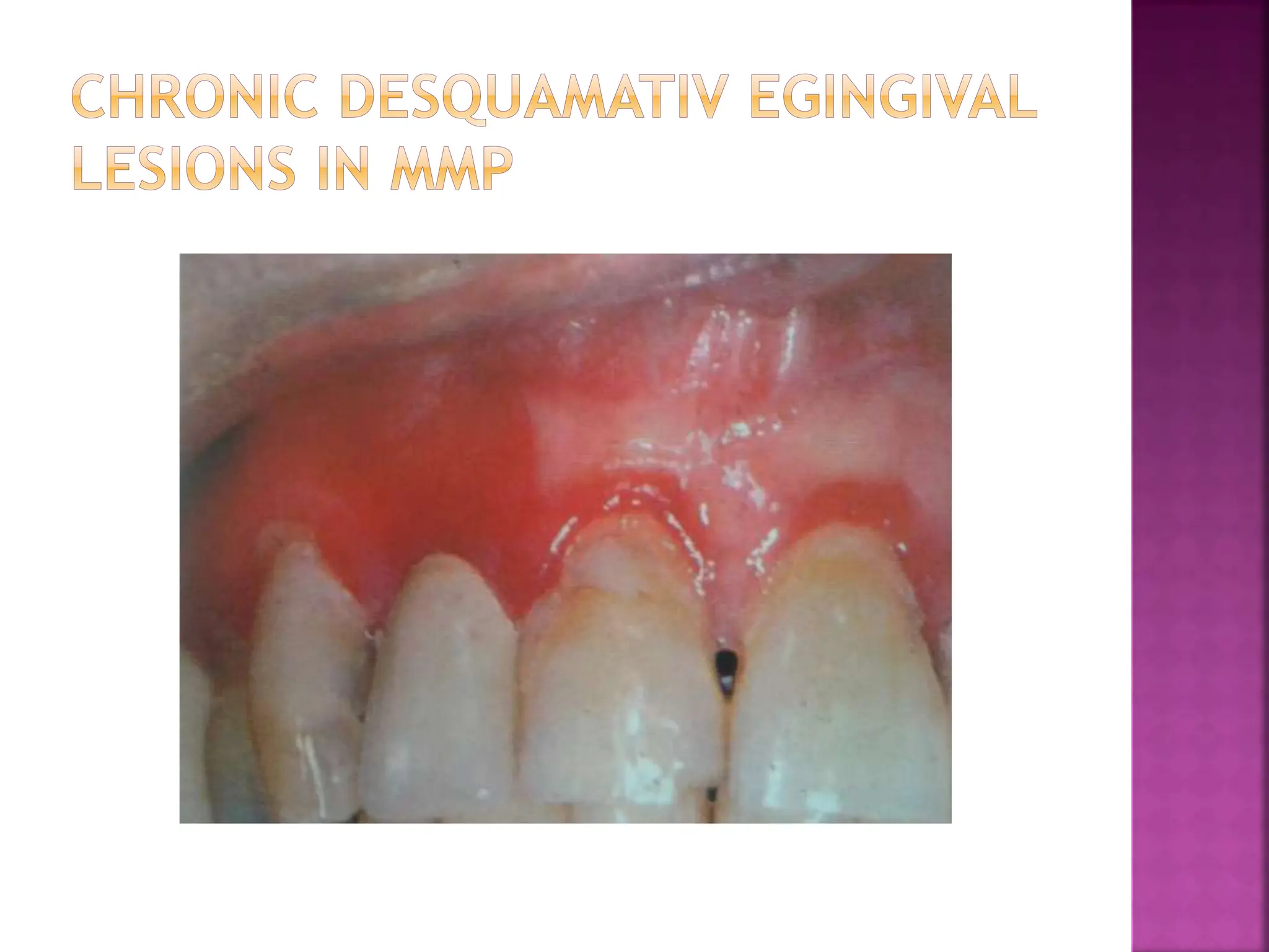 ULCERATIVE AND VESICULO BULLOUS LESIONS.pptx