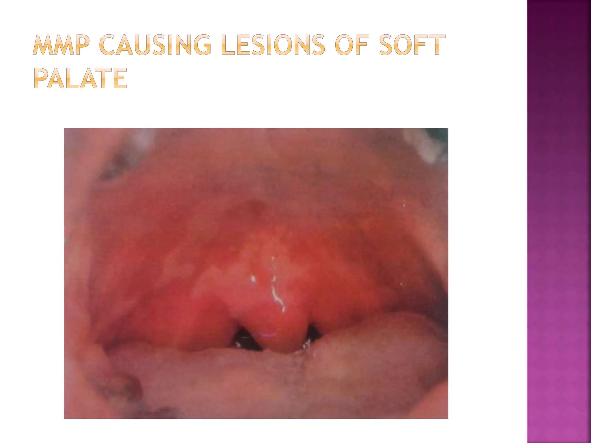 ULCERATIVE AND VESICULO BULLOUS LESIONS.pptx
