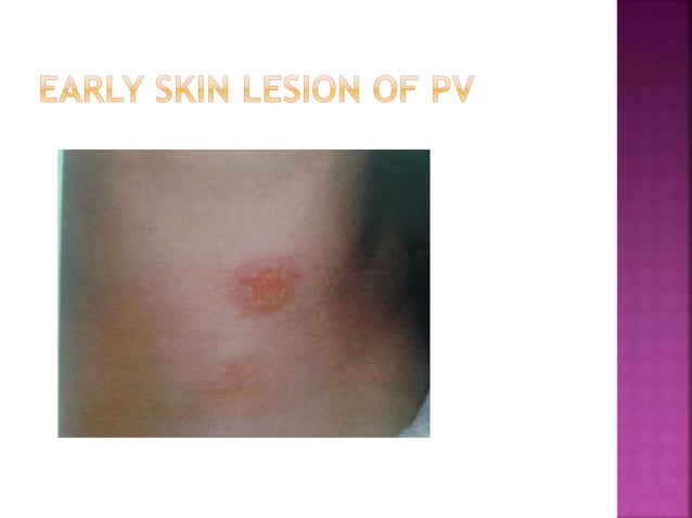ULCERATIVE AND VESICULO BULLOUS LESIONS.pptx