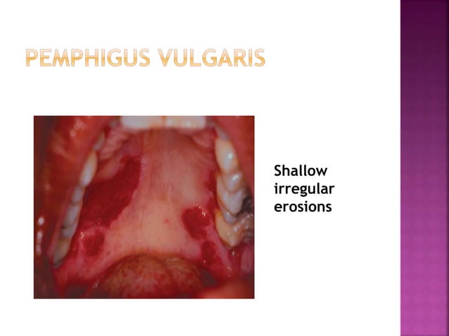 ULCERATIVE AND VESICULO BULLOUS LESIONS.pptx