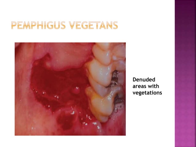 ULCERATIVE AND VESICULO BULLOUS LESIONS.pptx