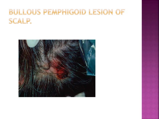 ULCERATIVE AND VESICULO BULLOUS LESIONS.pptx