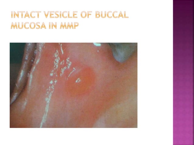 ULCERATIVE AND VESICULO BULLOUS LESIONS.pptx