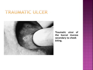 ULCERATIVE AND VESICULO BULLOUS LESIONS.pptx