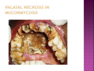 ULCERATIVE AND VESICULO BULLOUS LESIONS.pptx