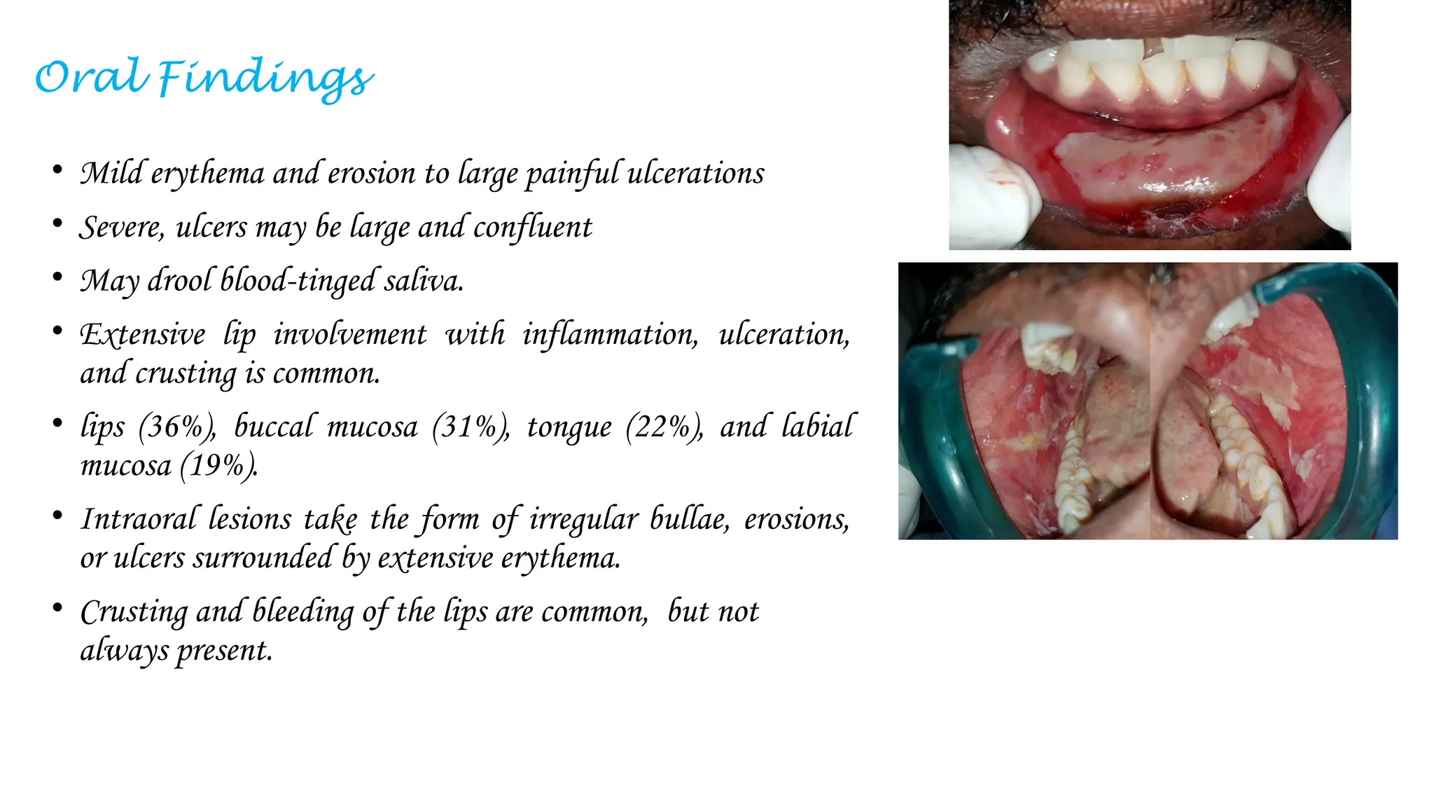 ULCERATIVE AND VESICULOBULLOUS LESIONS OF THE ORAL CAVITY.pptx