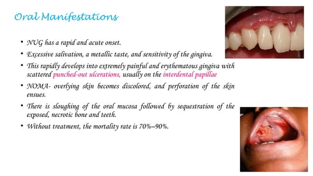 ULCERATIVE AND VESICULOBULLOUS LESIONS OF THE ORAL CAVITY.pptx