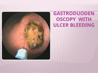 Ulcerative bleeding about ulcer bleeding.pptx