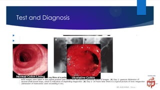Ulcerative colitis | PPTX